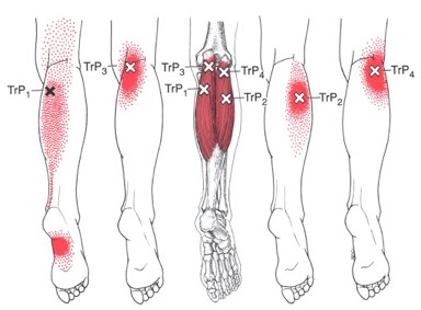 Your #1 Guide To a Calf Muscle Spasm Relief – Urban Health HQ